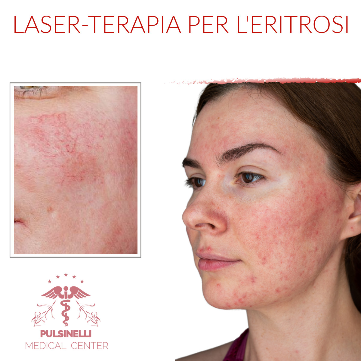 LASER-TERAPIA PER ERITROSI SUL VISO - tre sedute