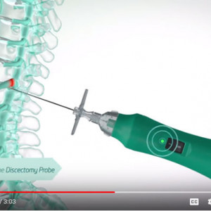 DISKOM - Dispozitiv pentru nucleoplastie