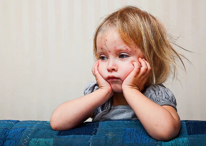 Varicela: simptome, tratament - Farmacia Nordpharm