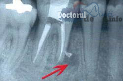 Pret rezectie apicala